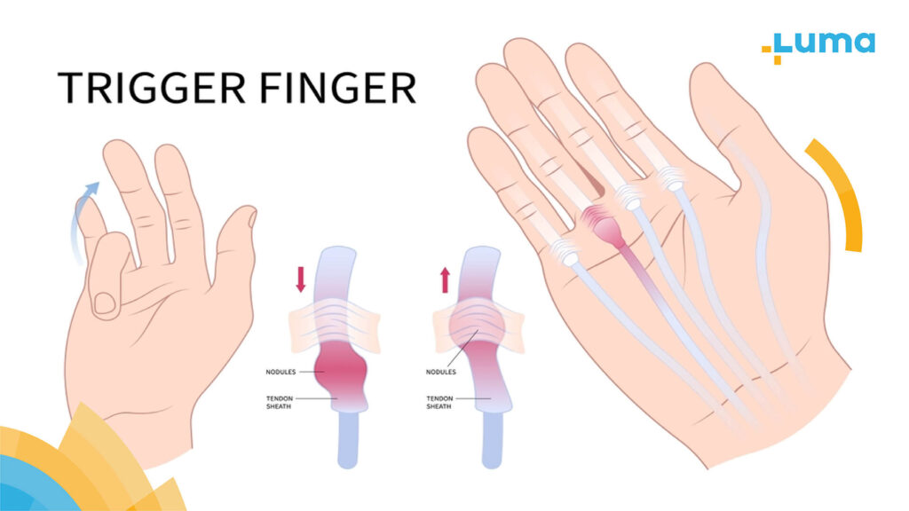 นิ้วล็อค ภัยใกล้ตัวที่ไม่ได้อยู่แค่พนักงานออฟฟิศ | LUMA