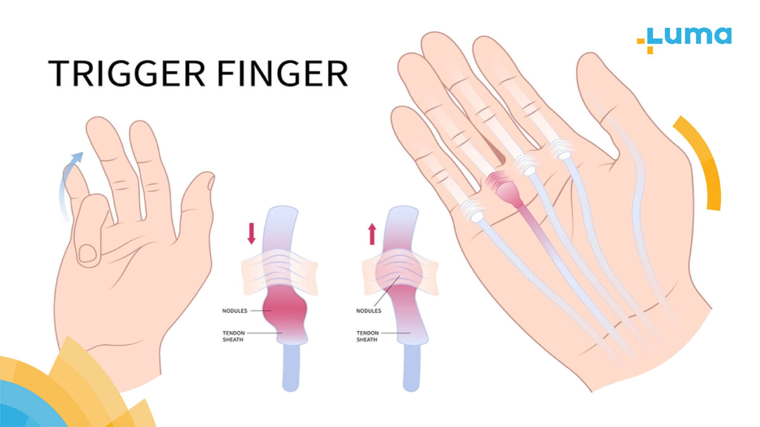 นิ้วล็อค ภัยใกล้ตัวที่ไม่ได้อยู่แค่พนักงานออฟฟิศ | LUMA